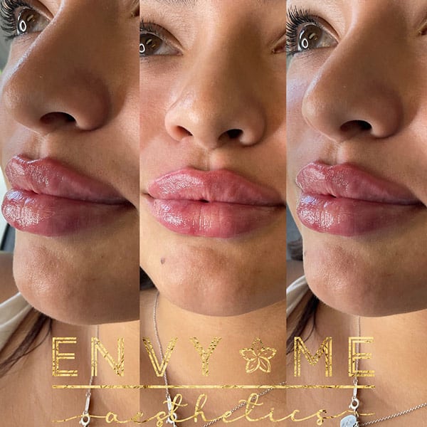 Envy Me Aesthetics Med Spa | Nonsurgical Facial Aesthetics with ...