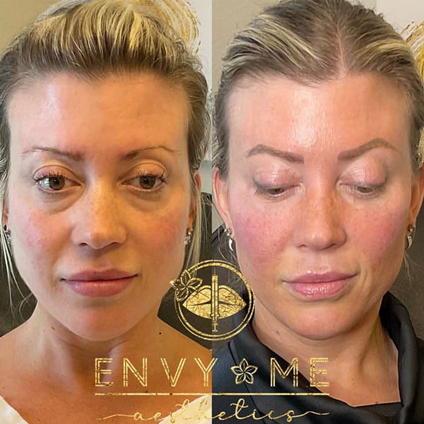 Liquid Face Lift/Facial Balancing Before and After Image Gallery | Envy ...