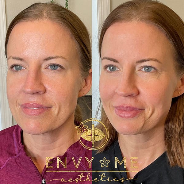 Liquid Face Lift/Facial Balancing Before and After Image Gallery | Envy ...