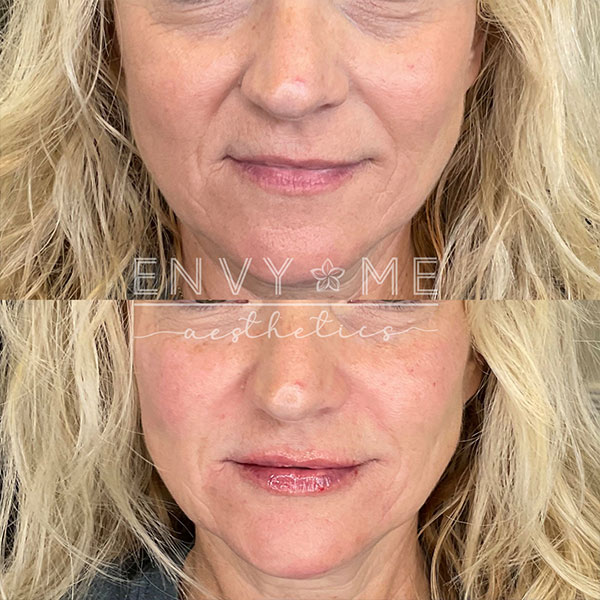 Mid Face, Nasolabial Folds, and Marionette Lines Before and After Image ...